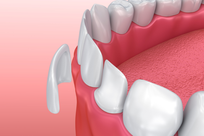 Dental Veneers Louisville, KY | Chipped Tooth, Stained Teeth
